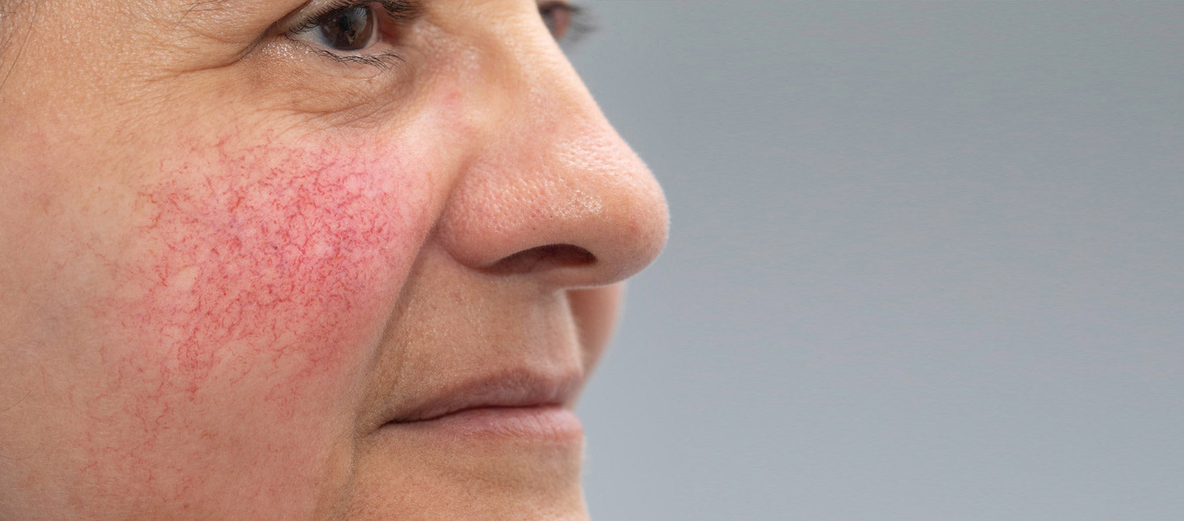 Rosacea, skin reddening, flushing – Renova Clinic